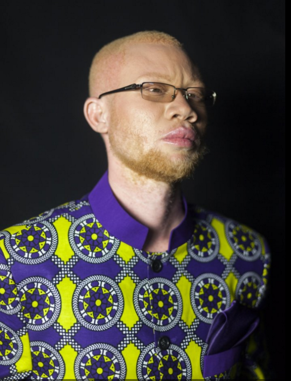 FEATURE: “Proudly Albino” brings albinism discrimination to the ...
