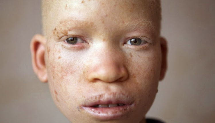 photography: ‘tribe of ghosts: albinism in tanzania’ – the work of ...